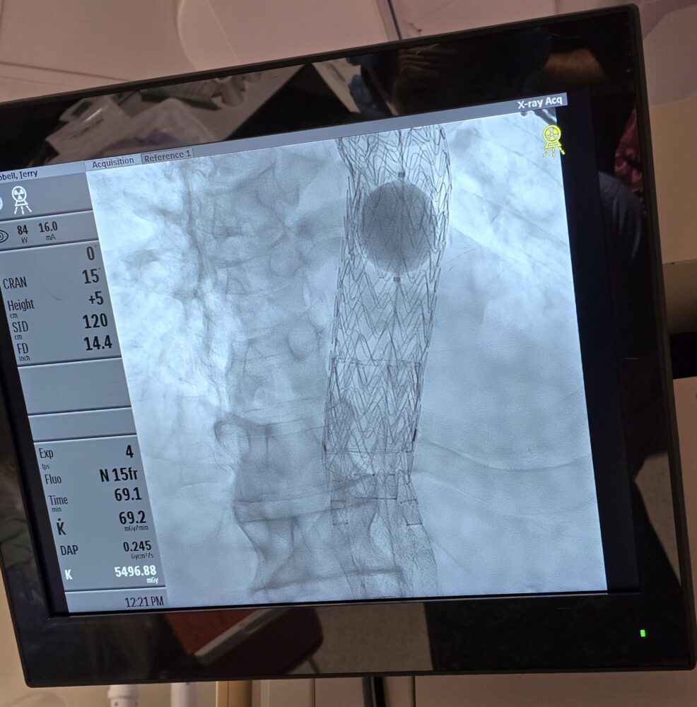 CRMC Performs First Thoracoabdominal Branch Endoprosthesis (TAMBE ...