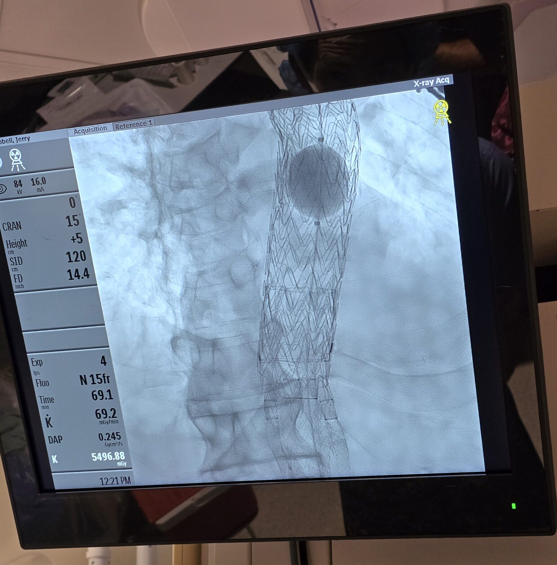 CRMC Performs First Thoracoabdominal Branch Endoprosthesis (TAMBE ...